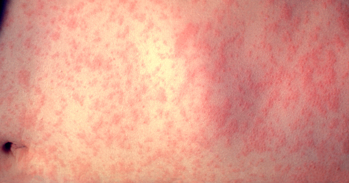 Early Symptoms Of Measles