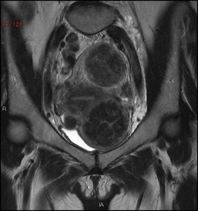 Ct Scan Of The Pelvis Hip Bones Los Angeles Ca Cedars Sinai