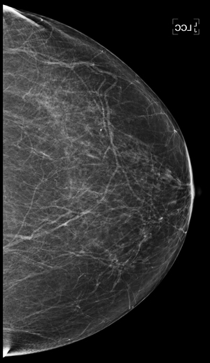 Breast Exam Mammogram